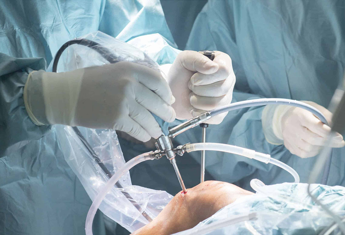 Surg-N-Flow Orthopaedic Suction Device Set Available in The USA and ...